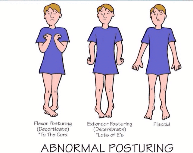Posture Comparison Decorticate Vs Decerebrate