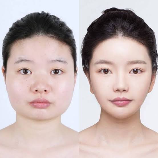 V-Line Surgery Vs. Fillers: Which Is Right For Achieving A Slimmer Face?