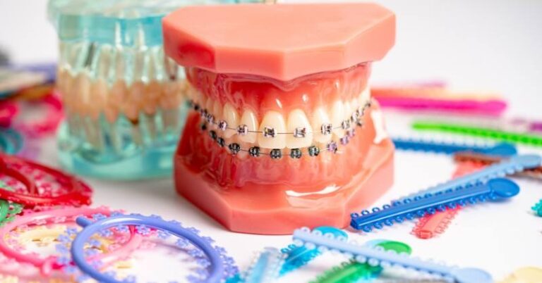 Dental Bands: What They Are And How They Improve Your Braces Treatment